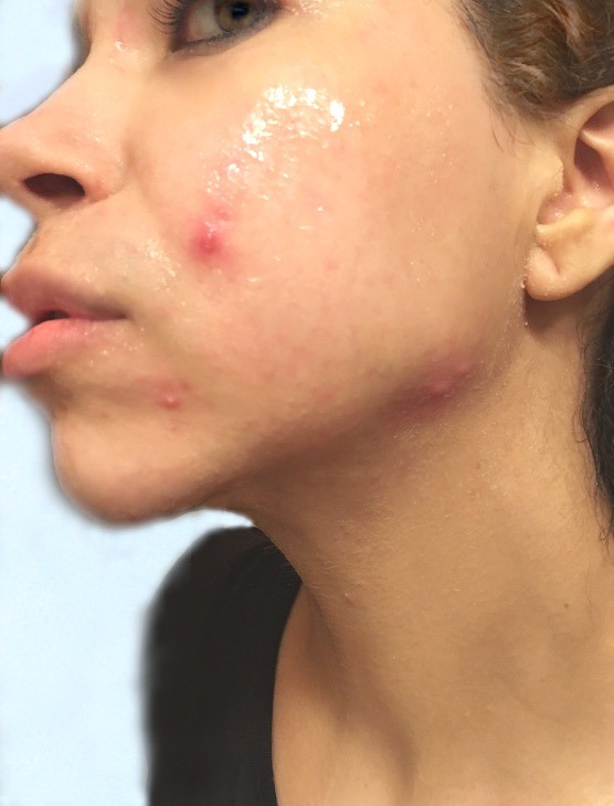 Differin Gel - Results for Adult Acne and Regular Pimple Review